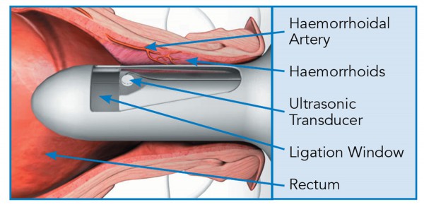 About HAL-RAR - Got Hemorrhoids by A.M.I.